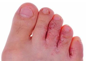 Les mycoses des pieds traitement - Micinorm